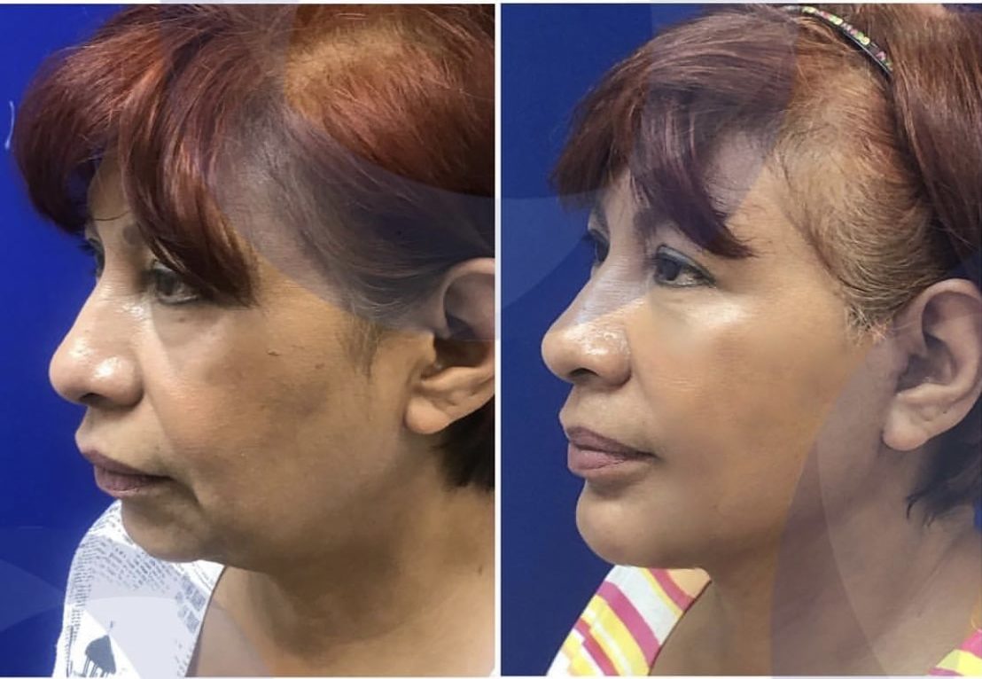 Facial Lifting - MD. José Cortés