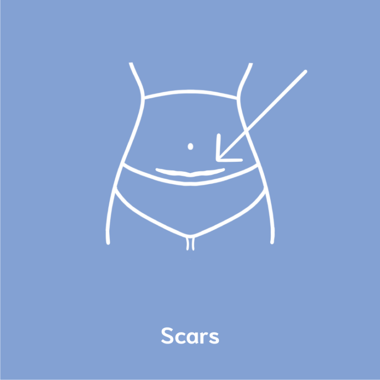 Treatment of keloid scars - MD. José Cortés